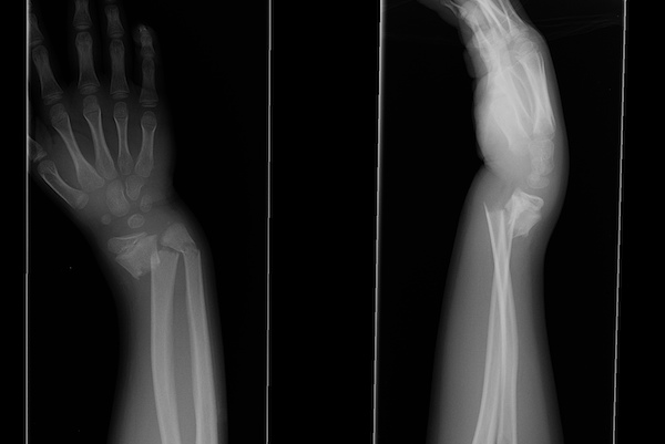 Distal Radius Fracture